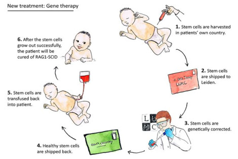 LUMC will administer first Dutch stem cell gene therapy to patients ...